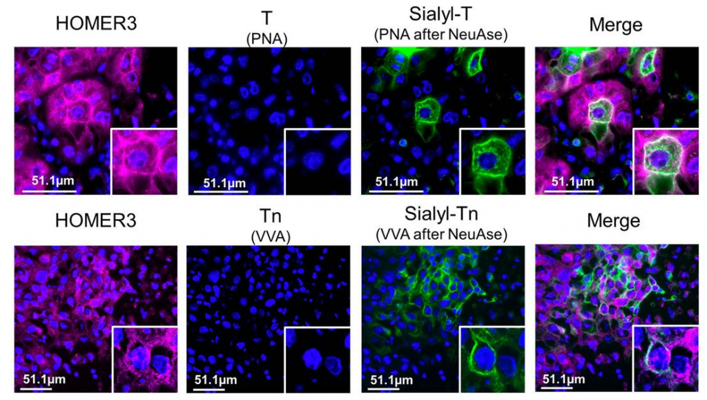 HOMER3 with sialyl-T and sialyl-Tn antigen could be a therapeutic ...